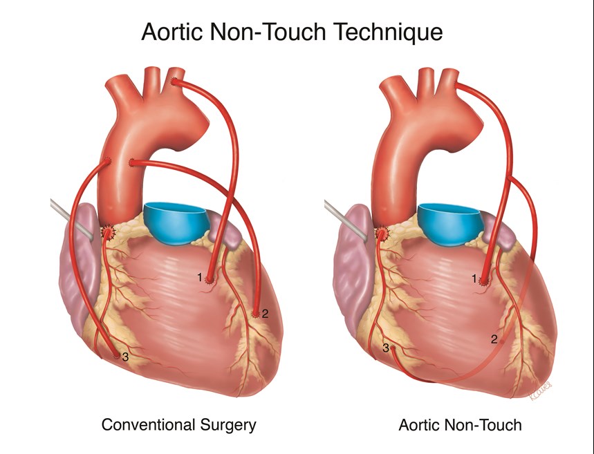 Liverpool Heart and Chest Hospital | Coronary Artery Bypass Grafting